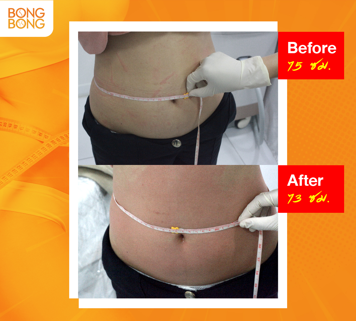 Liposlim Vacuum - กระชับสัดส่วนแบบไม่ต้องผ่าตัด