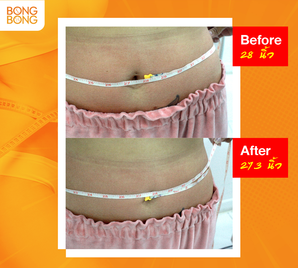 Liposlim Vacuum - กระชับสัดส่วนแบบไม่ต้องผ่าตัด