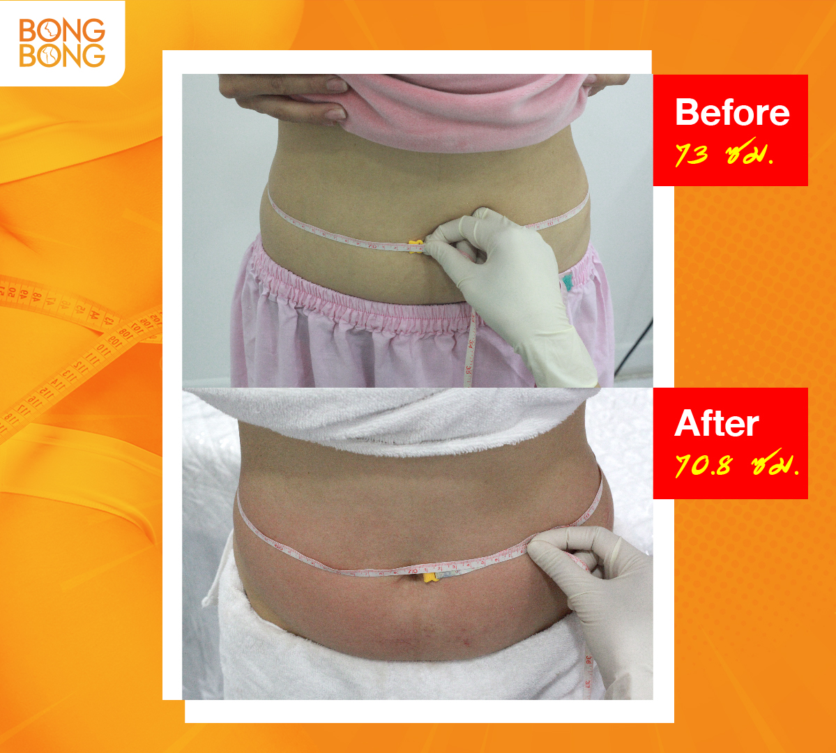 Liposlim Vacuum - กระชับสัดส่วนแบบไม่ต้องผ่าตัด